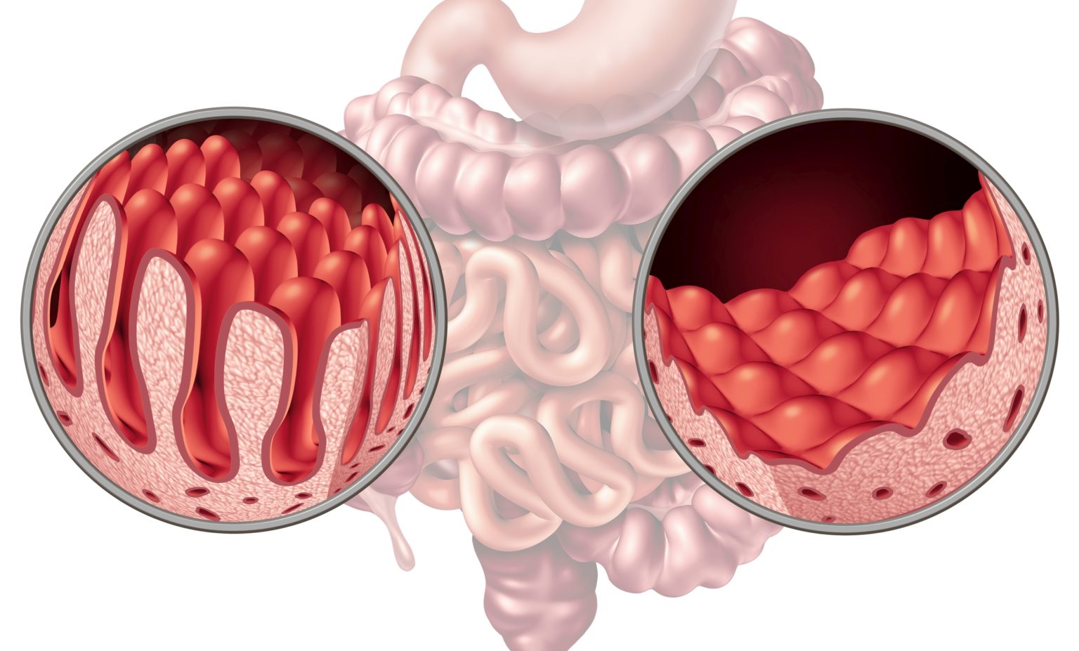 Celiac disease - AGA GI Patient Center