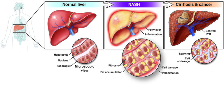 Metabolic dysfunction-associated steatotic liver disease (MASLD) and ...
