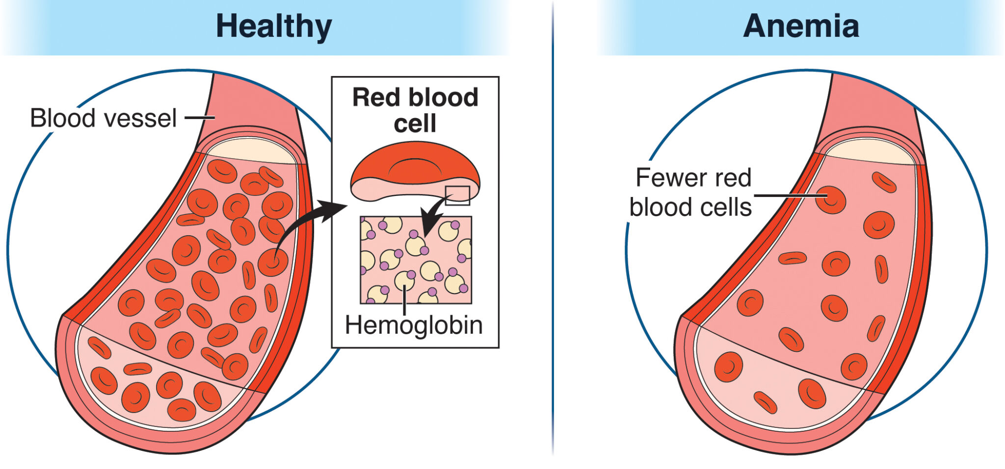 Iron deficiency anemia - AGA GI Patient Center